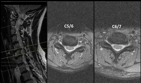 Acdf Joshua Li Md Phd