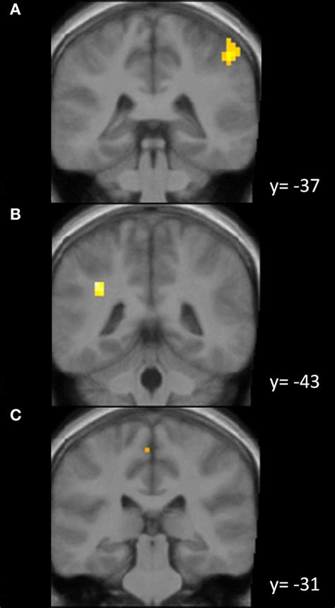 Activations In The Parietal Lobe A Activation In The Right Inferior Download Scientific