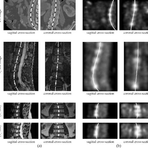 Pdf Automated Detection Of Spinal Centrelines Vertebral Bodies And Intervertebral Discs In Ct