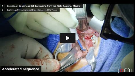 Treatment Of Squamous Cell Carcinoma From Posterior Maxilla With Wide Local Excision Of The