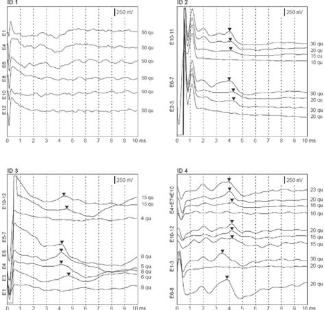 Electrically Evoked Auditory Brainstem Responses Eabrs For All Four Download Scientific