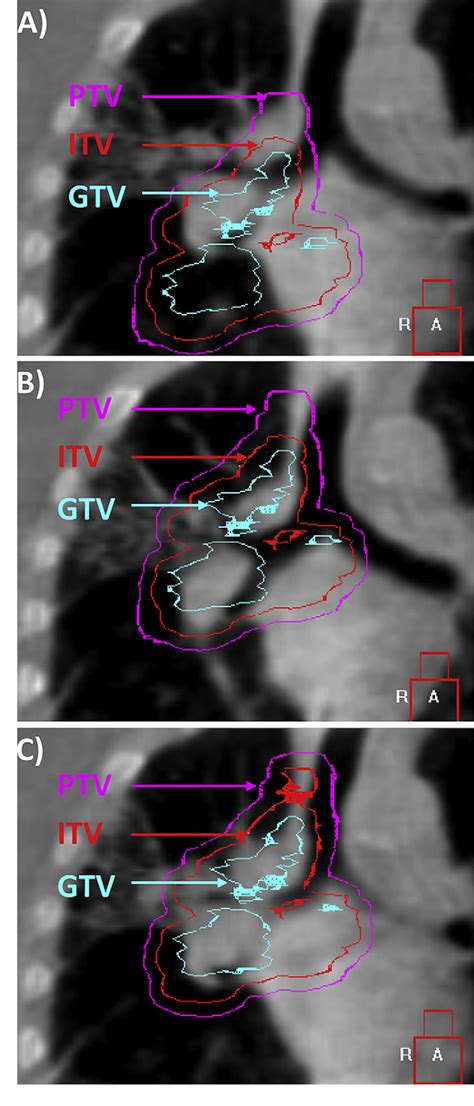 Figure 1 From Clinical Investigation Thoracic Cancer Volumetric Image Guidance Using Carina Vs