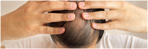 Scalp Calcification Does It Cause Hair Loss