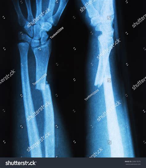 X Ray Image Legs Bone Fracture Foto Stok 220613575 Shutterstock