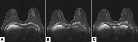 Case Invasive Lobular Carcinoma Radiology Ucla Health