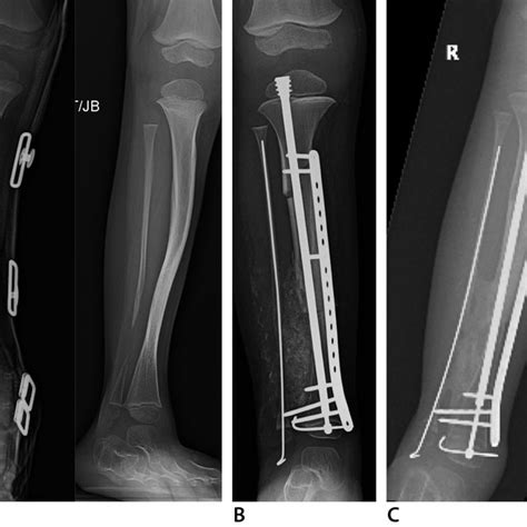 Paley Classification Of Congenital Pseudarthrosis Of The Tibia Type 1 Download Scientific