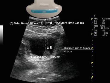 Specular Reflection Ultrasound