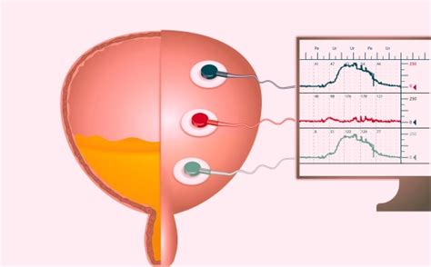 When Is Bladder Tumor Removal Needed Medisuggest