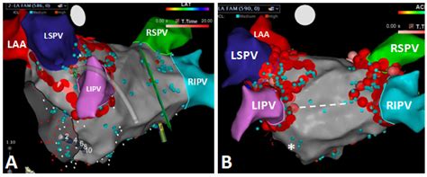 Pulmonary Vein Isolation Pvi And Ablation Of Atrial Fibrillation
