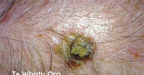 Erosive Pustular Dermatosis Of The Scalp Image