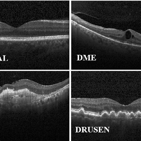 schematic representation of choroidal neovascularization download