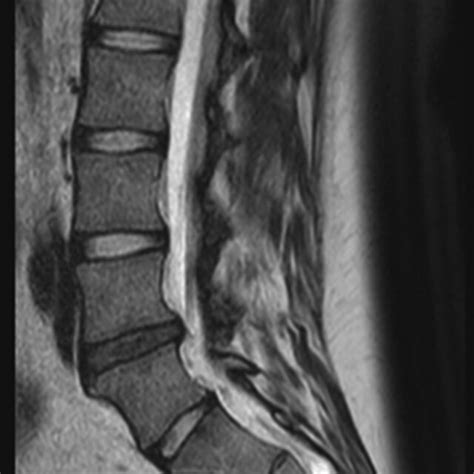 T2‐weighted Magnetic Resonance Imaging Mri Sagittal Reconstruction Of Download Scientific