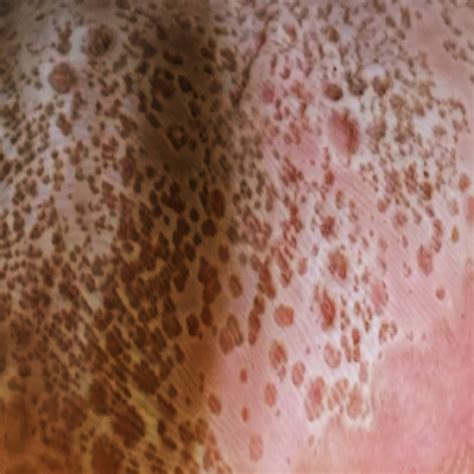 [소와각질융해증 증상 원인 치료] 손 발에 구멍이 네이버 블로그