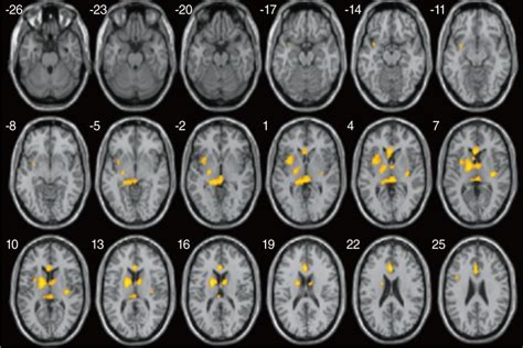 Two Sample Statistical Parametric Mapping Spm Axial Maps Rendered On Download Scientific