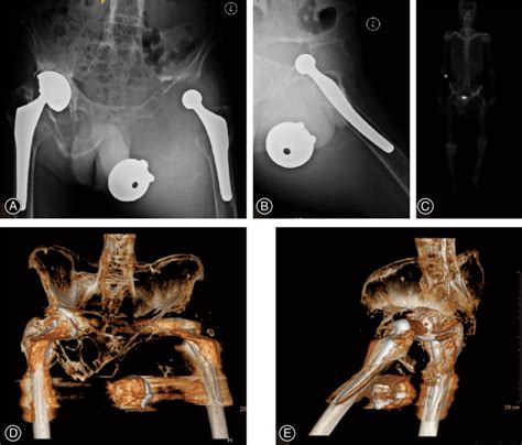 Preoperative Radiograph Imaging Of The Pelvis Demonstrating Download Scientific Diagram