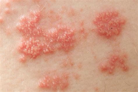 Postherpetic Neuralgia Treatment Symptoms And Causes