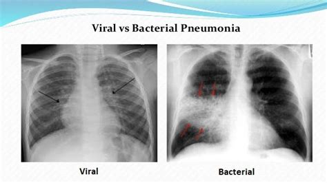 Pneumonia Chest X Rays — Image Classifier By Abhik Jha Medium