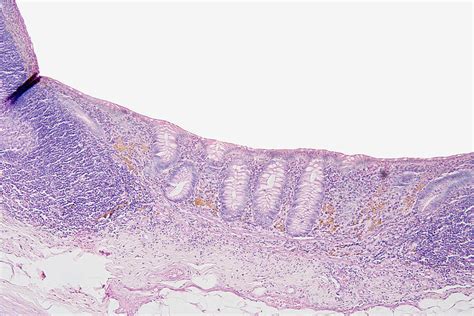 Cross Section Of Human Appendix Lm Photograph By Science Stock Photography Fine Art America