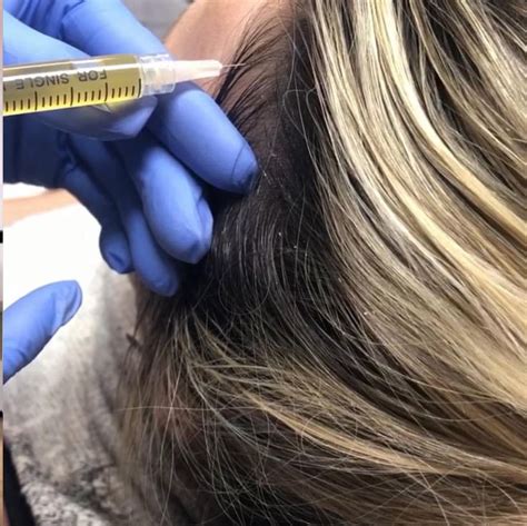 Liquid Gold 🍯 Platelet Rich Plasma Prp ⭐️ Prp Is Injected Into The Scalp To Help “wake Up