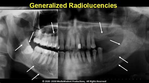Acclaimed Lectures On Radiolucent And Radiopaque Lesions Of The Jaws2024