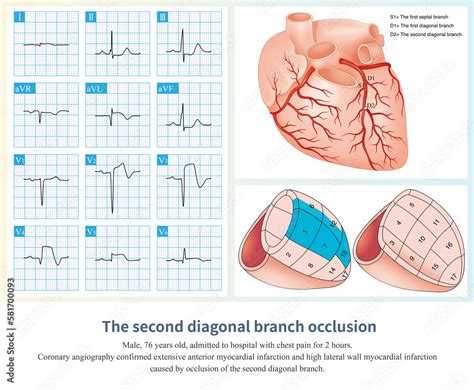 When The Second Diagonal Branch Of The Lad Is Occluded It Causes A Localized Left Ventricular