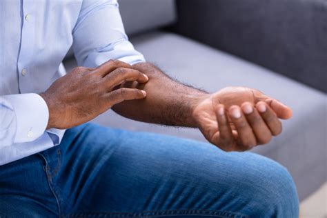 Psoriasis On Dark Skin Appearance Diagnosis Management