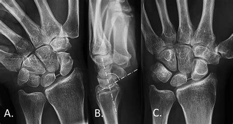 An Algorithmic Diagnostic Approach To Scapholunate Ligament Injuries