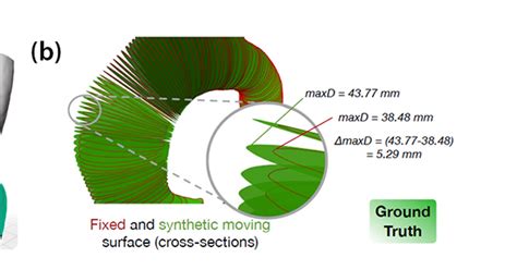 Accurate And Reliable Measurement Of Thoracic Aortic Aneurysm Growth Siam