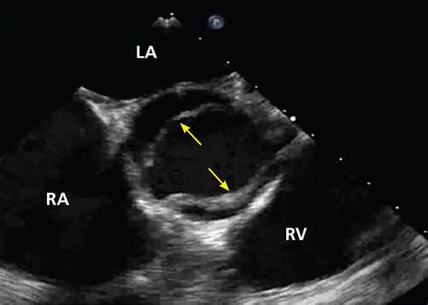 Aortic Valve Echo