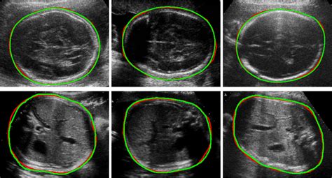 Pdf Cascaded Fully Convolutional Networks For Automatic Prenatal Ultrasound Image Segmentation
