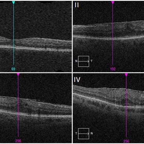 Stages Of Erm Showed On Optical Coherence Tomography Oct Images I Download Scientific