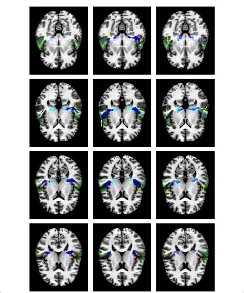 sual comparison of the segmentation masks on one subject of the