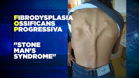 Stone Man Syndrome