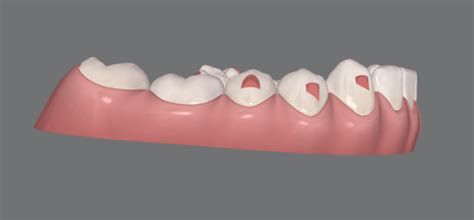 What Is The Pir Protocol Marso Clínica Dental