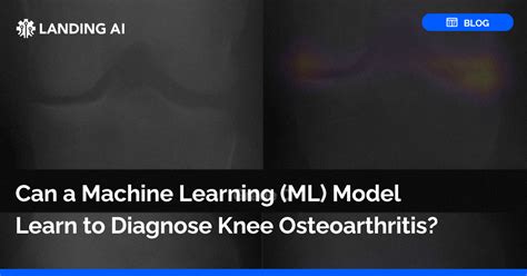 Machine Learning In Orthopedics Diagnose Knee Osteoarthritis