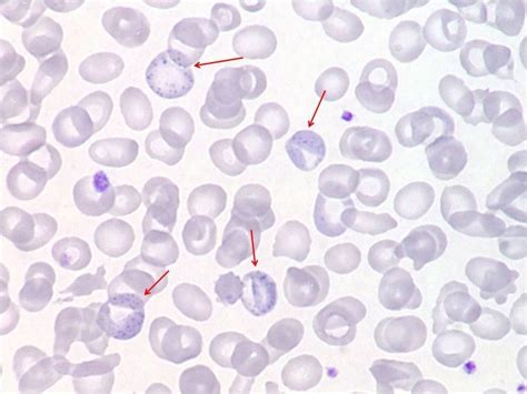 Beta Thalassaemia Minor