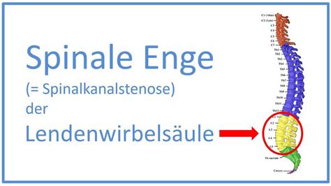 Spinale Enge — Konservativ Oder Operativ Behandeln Kqtruc