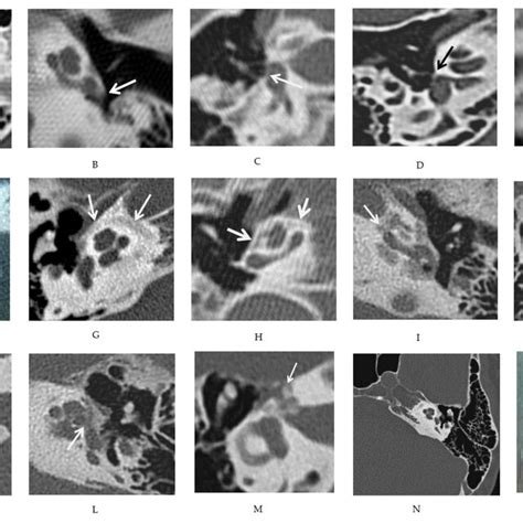 High Resolution Of Temporal Bone CT Anomalies In OI Windows A Oval