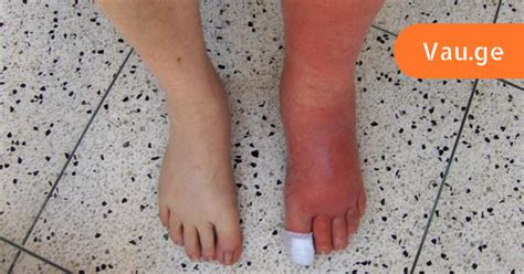 ტრადიციული ნარევი რომელიც დაავადება წითელი ქარის დროს მყისიერად დაგეხმარებათ Vap Ge