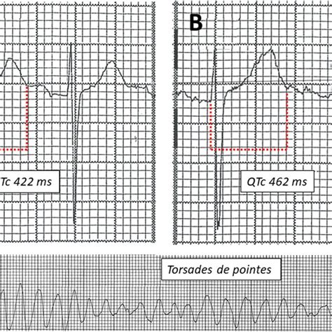 Electrocardiogramsa Normal Ecg With Corrected Qt Interval Qtc Of Download Scientific