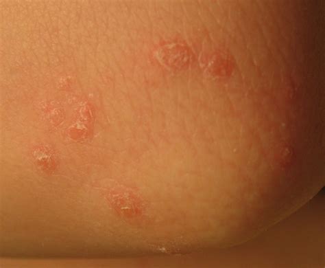 Метотрексат при псориазе отзывы инструкция по применению