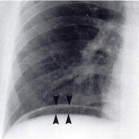 Pdf Pneumoperitoneum After Laparoscopic Cholecystectomy Frequency And Duration As Seen On