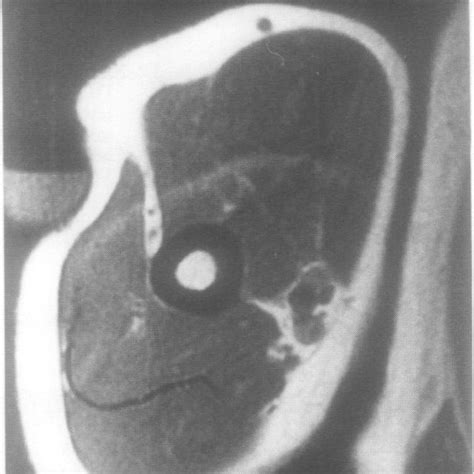 Preoperative V Pattern Exotropia Over Elevation In Adduction Download Scientific Diagram
