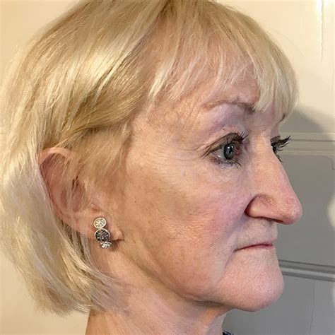 Mini Facelift Face And Neck Thread Lift At The Norup Clinic Esher