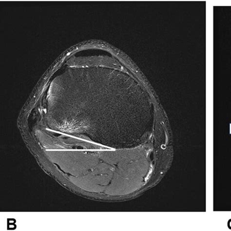 Tibial Internal Rotation According To Anterolateral Ligament Injury Download Scientific Diagram