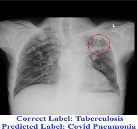 An Input Test Cxr Image Belonging To The Tuberculosis Class Download Scientific Diagram
