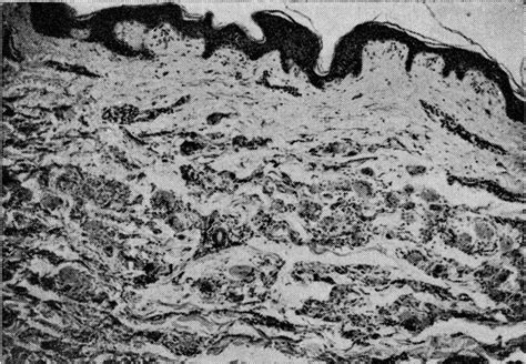Pseudoxanthoma Elasticum Abstract Europe Pmc
