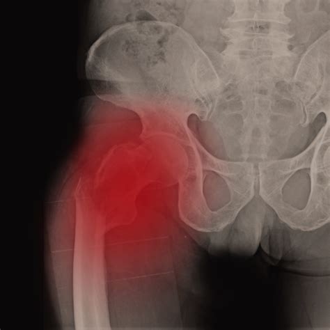 Fascia Iliaca Block RCEMLearning