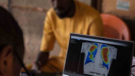 Strategising For Impactful TB Screening