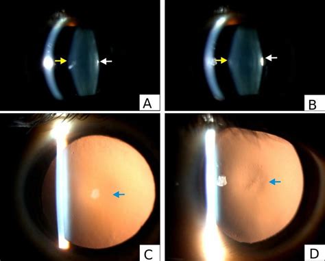 Alport Syndrome With Bilateral Simultaneous Anterior And Posterior